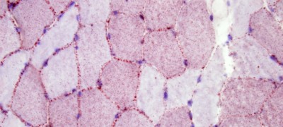 Muscle Biopsy - Muscle Pathology Overview - Therapath Neuropathology