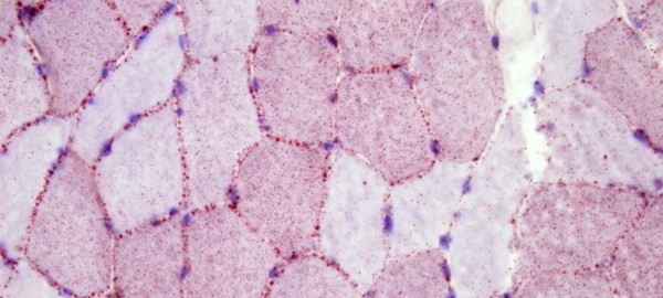 Muscle Biopsy - Muscle Pathology Overview - Therapath Neuropathology