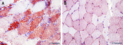 Muscle Biopsy - Muscle Pathology Overview - Therapath Neuropathology