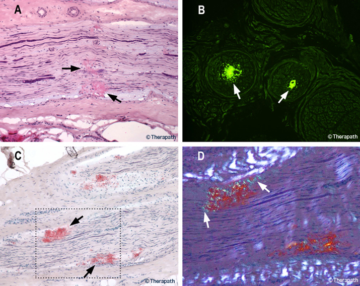 Nerve Biopsy - Nerve Pathology Overview - Therapath Neuropathology