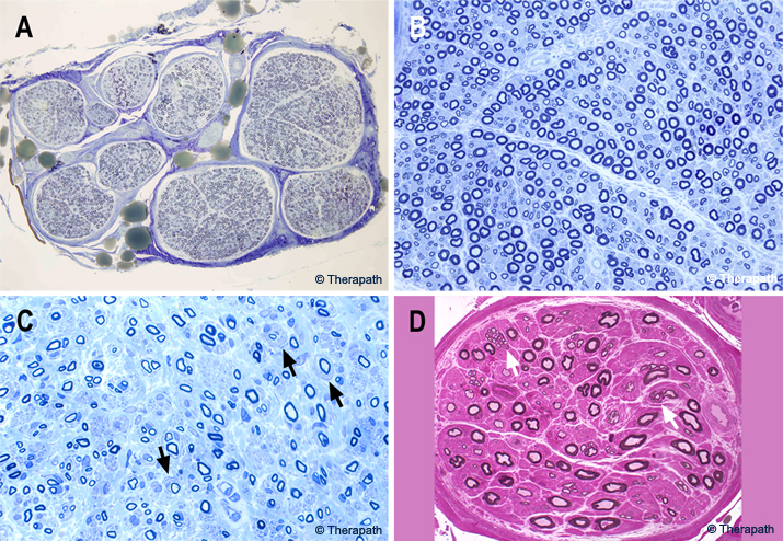 Nerve Biopsy - Nerve Pathology Overview - Therapath Neuropathology